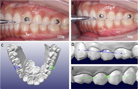 Schematic Diagram Of The Intraoral Orthodontic Device A Measurement