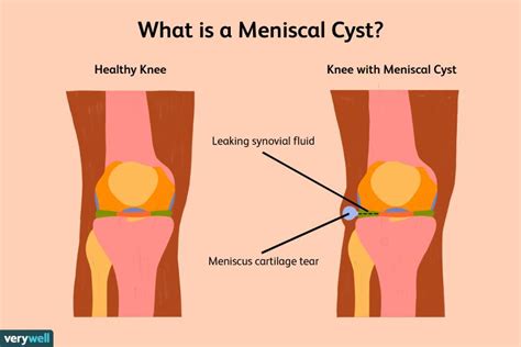Meniscal Cysts Symptoms Causes Diagnosis And Treatment