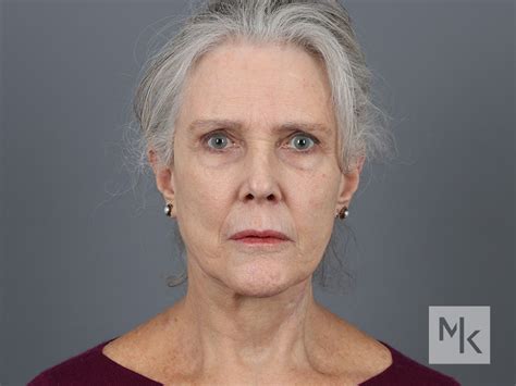 Facelift Before And After 10 Dr Michael Kim