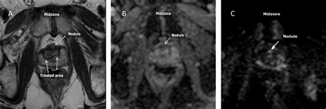 Diagnostic Accuracy Of Multiparametric Magnetic Resonance Imaging To Detect Residual Prostate