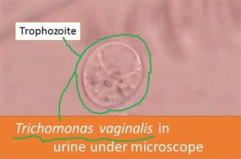 Trichomonas Vaginalis In Urine And Its Details Lab Diagnosis And Treatment