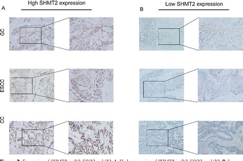 Figure 3 From High Expression Of Shmt2 Is Correlated With Tumor