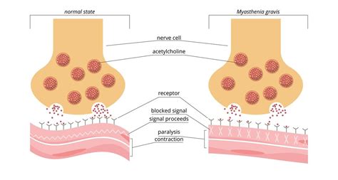 Myasthenia Gravis Rozanolixizumab Vor Der Zulassung News Deutsches Ärzteblatt