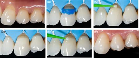 Adhesive Dentistry Ceramics At Lori Francois Blog