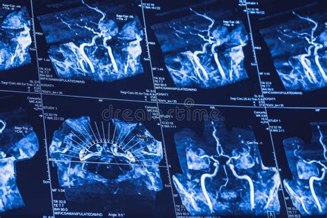 Balayage D IRM Des Navires Cérébraux De Cerveau Tomographie Rayon X