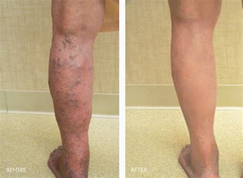Chronic Venous Insufficiency Treatment Venous Reflux Los Angeles