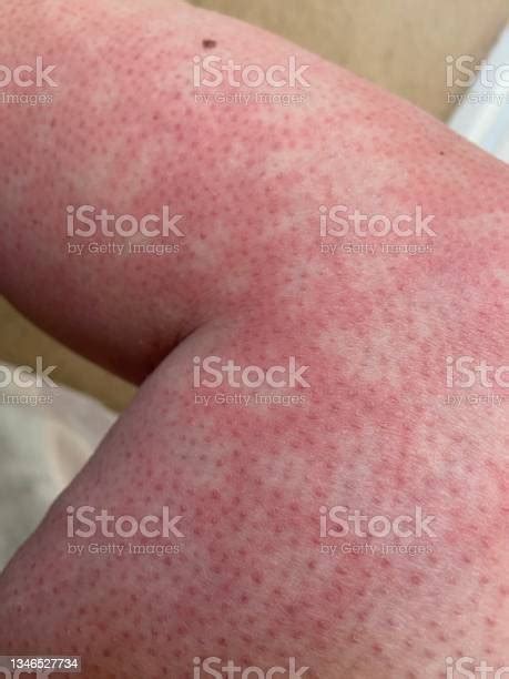 Hives Heat Rash Eai Erythema Ab Igne Heat Reaction On Knee Closeup