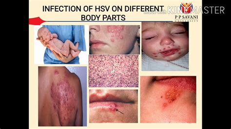 Herpes Simplex Symptoms Pictures Types Treatment