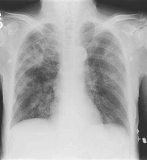 Chest Radiograph Of A 79 Year Old Male With Bilateral Patchy Opacities Download Scientific