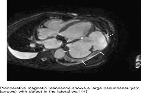 Left Thoracotomy For Recurrent Left Ventricular Pseudoaneury Journal Of Cardiovascular Medicine
