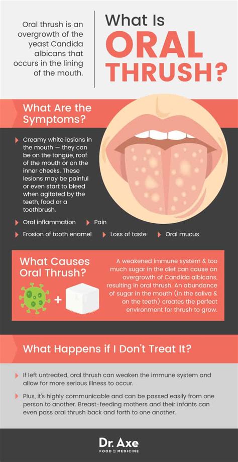 Oral Thrush And 18 Natural Treatments To Relieve It Dr Axe