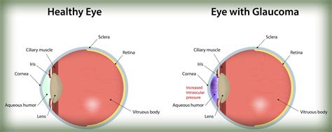 Five Simple Eye Test Can Detect Glaucoma The Best Eye Hospital In