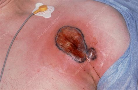 Infected Pacemaker Stock Image C0365814 Science Photo Library