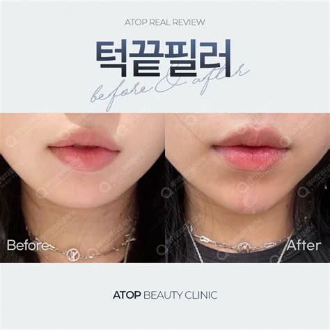 에이탑뷰티클리닉┃필러보톡스피부관리 턱 끝 변화 하나로 더 세련된 턱 라인을 만들 수 있어요 자연스럽게 얼굴 포인트를