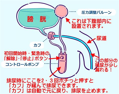 『人口尿道括約筋手術』 やぶちゃんの興味津々