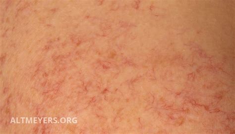 Telangiectasia Macularis Eruptiva Perstans Histology