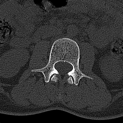 Normal Ct Lumbar Spine Radiopaedia 53981 60118 Axial Bone Window Nc Commons