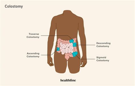 Colostomy Bag Types