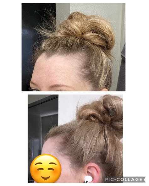 Oral Minoxidil Dread Shed Rfemalehairloss