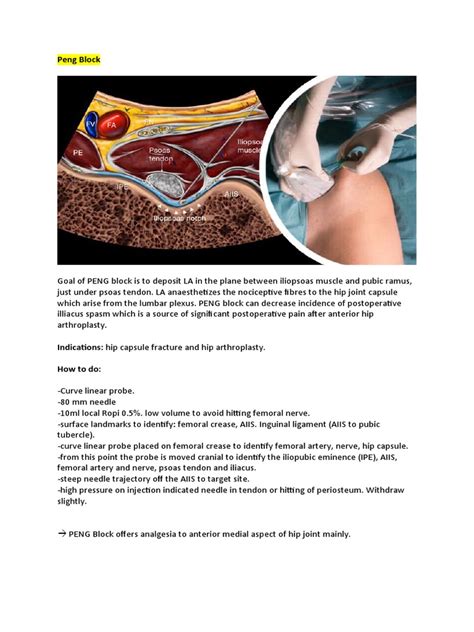 Peng Block For Hip Surgery Pdf Peng Block For Hip Surgery Pdf