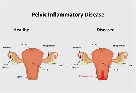 Pelvic Inflammatory Diseases Pid Reasons Symptoms And Treatment