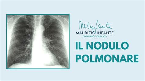 Cosè Un Nodulo Polmonare Analisi Della Lesione Dr Maurizio Infante