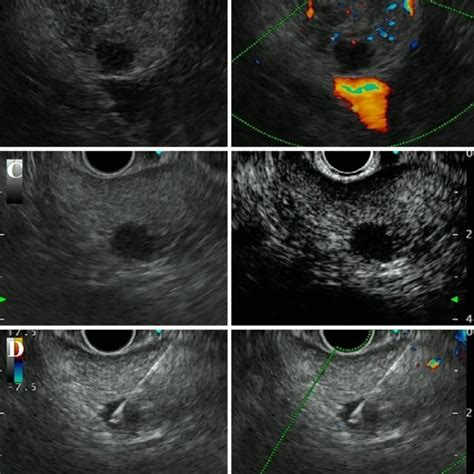 Figure4endosonography And Eus Guided Fine Needle Biopsy Findings A A