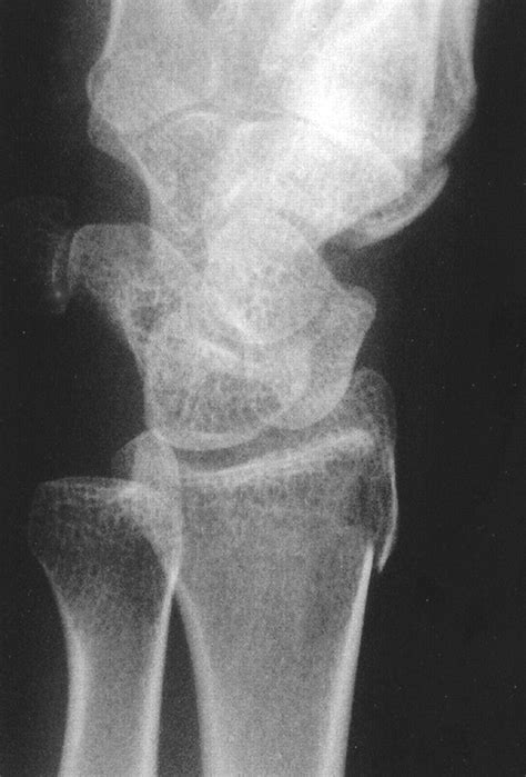 Arm Fracture X Ray Oblique