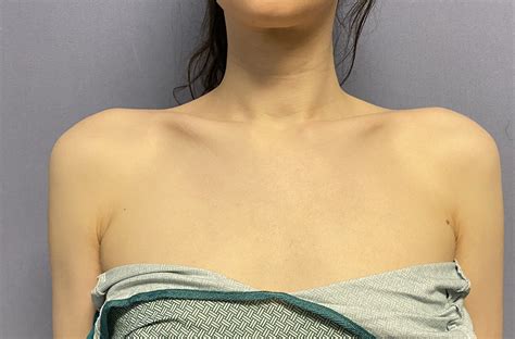 Female Shoulder Reduction Before Front 1 Dr Barry Eppley Explore