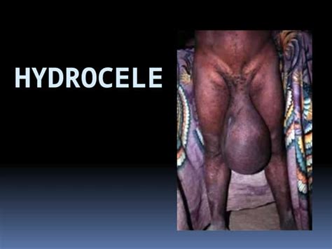 Hydrocele Ppt