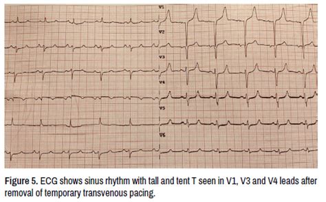 Clinical Case Reports Transvenous