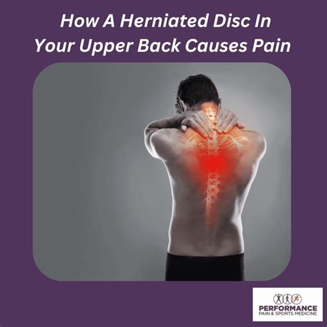 How A Herniated Disc In Your Upper Back Causes Pain Performance Pain