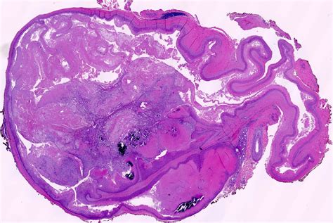 Proliferating Pilar Cyst