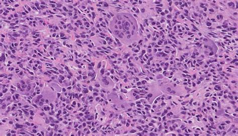 Votre Rapport Danatomopathologie Concernant Une Tumeur à Cellules