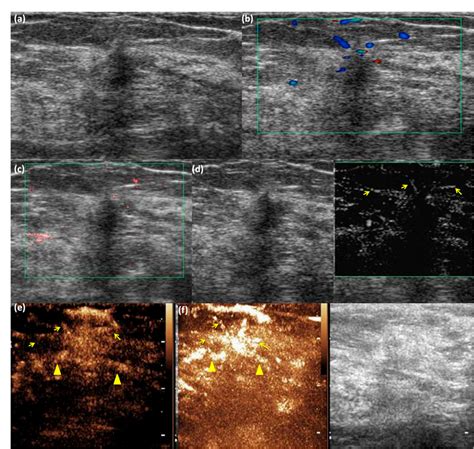 Figure 1 From Superb Microvascular Imaging In Diagnosis Of Breast