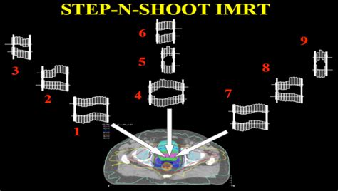 Sketch Of Step And Shoot Imrt 3 Download Scientific Diagram