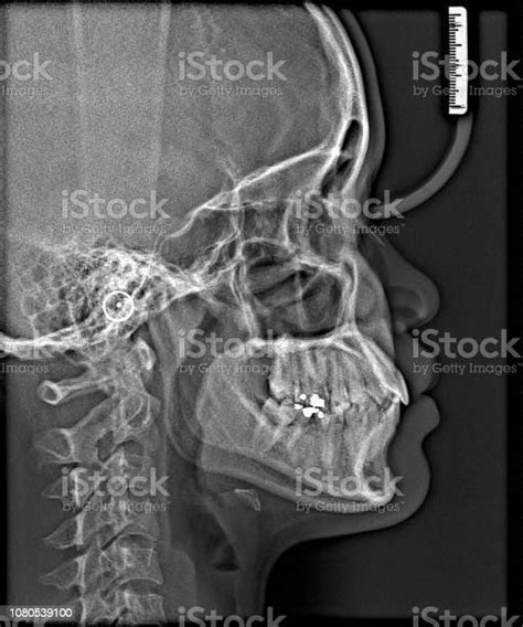 X 선 필름 머리와 입 X 레이에 대한 스톡 사진 및 기타 이미지 X 레이 건강 진단 건강관리와 의술 Istock