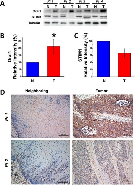 Elevated Orai1 Expression Mediates Tumor Promoting Intracellular Ca2