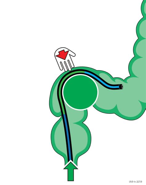 [diagram] Diagram Of The Hepatic Flexure Mydiagram Online
