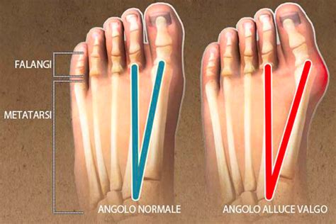 Alluce valgo cos è che cosa si può fare per curarlo