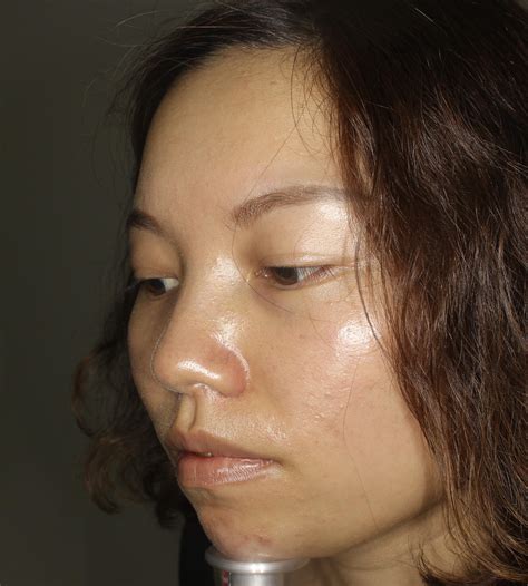 Acne04 Object Detection Dataset V1 2023 01 30 12 23pm By Andrei Dore