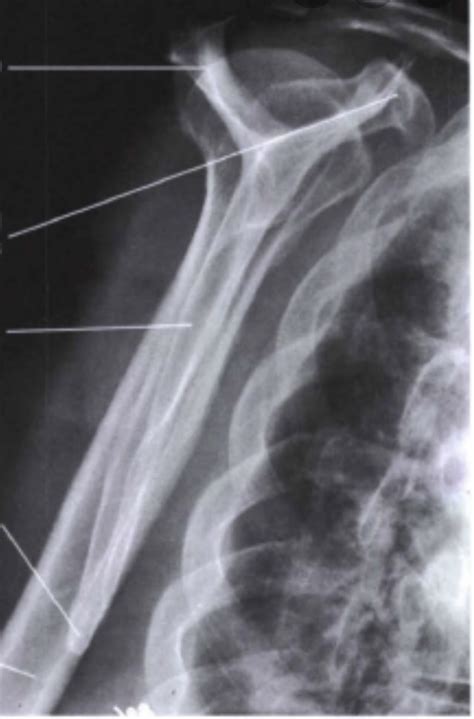 Scapular Y Diagram Quizlet