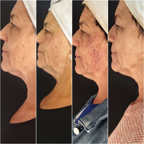 Laser Pigmentation Removal Beautilase