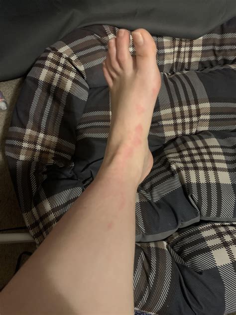 I Get This Rash On My Feet Almost Every Time I Shower Does Anyone Else