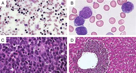 Histological Features Of Leukemic Cells A Wright Giemsa Staining Of