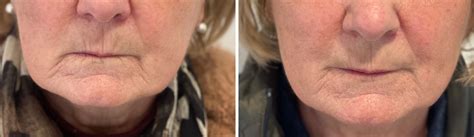 Perioral Lines Filler Treatment Bishops Waltham And Otterbourne Uk