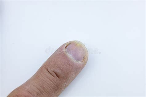 Close Up Of Hand And Fingers With Psoriatic Onychodystrophy Or