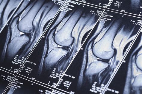 Bone Scan What Does The Doctor Say