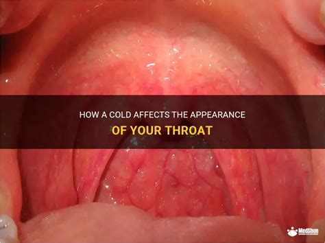 How A Cold Affects The Appearance Of Your Throat Medshun