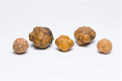 Which Size Of Gallbladder Stone Is Dangerous Eremedium